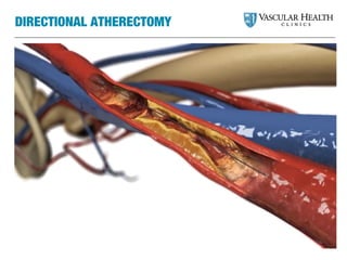 Catheter Based Intervention and Surgical Management of Peripheral Arterial Occlusive Disease ...