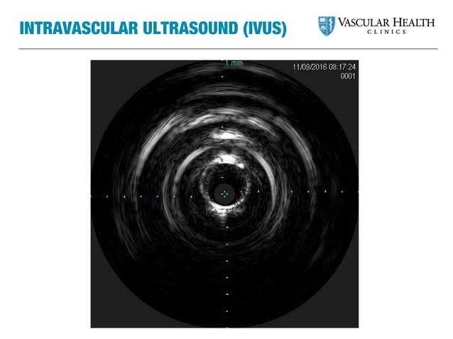 Catheter Based Intervention and Surgical Management of Peripheral ...