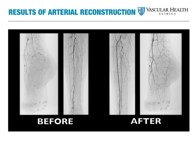 Catheter Based Intervention and Surgical Management of Peripheral ...