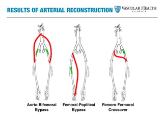 Catheter Based Intervention and Surgical Management of Peripheral ...