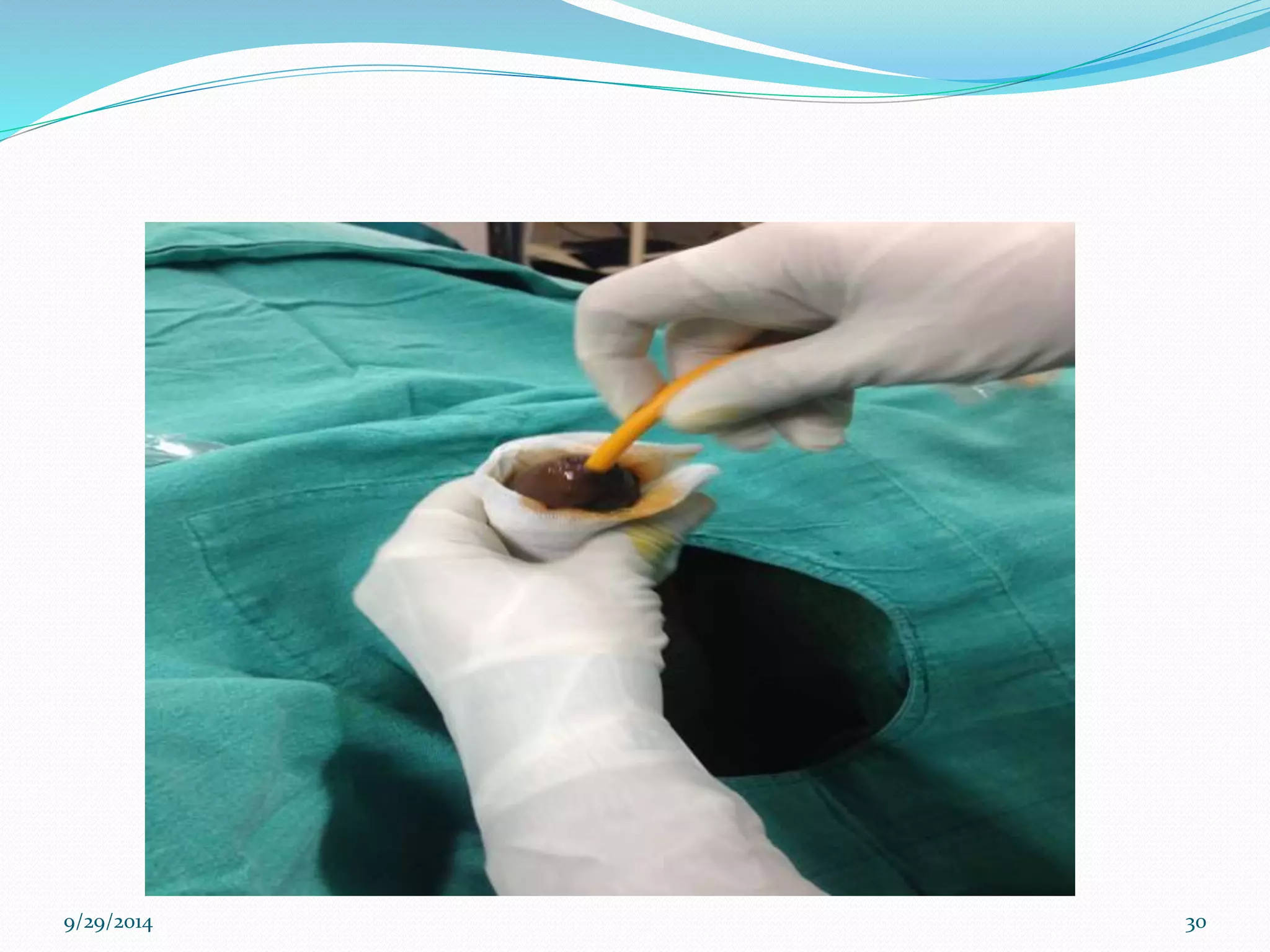 URINARY CATHETER SKILLS AND CARE: DR SWAPNIL TOPLE, DNB UROLOGY | PPTX