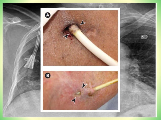 Catheter related infections- DR Nadia Mohsen | PPTX | Infectious ...
