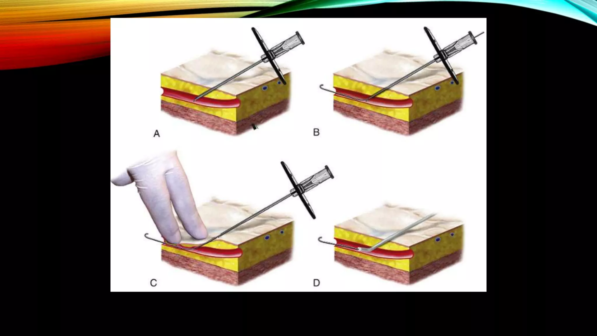 Interventional Radiology : Devices and Embolic Agents that a Resident ...