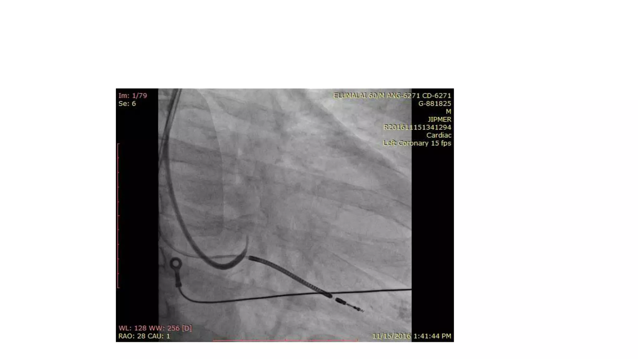technical aspect of Left ventricular lead placement for CRT | PPTX