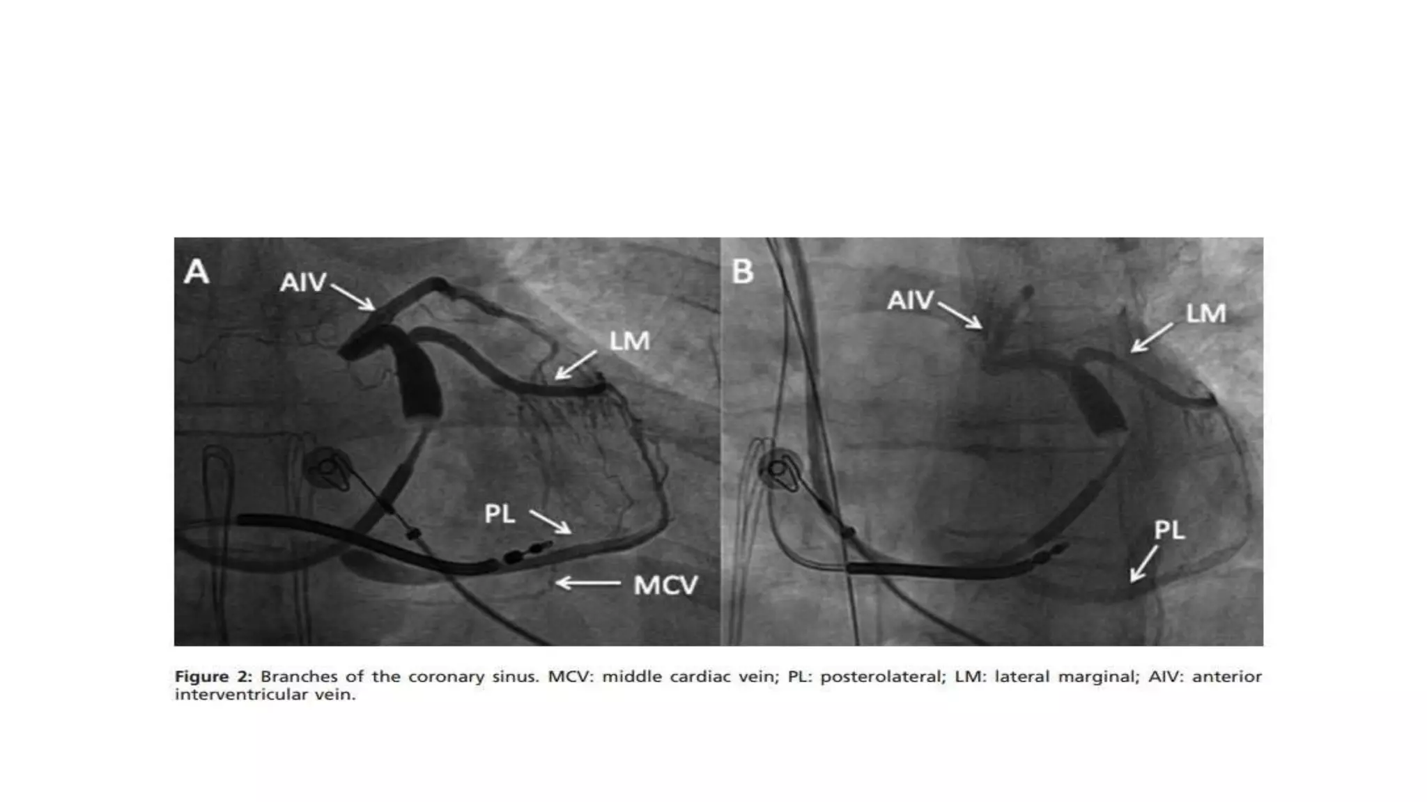 technical aspect of Left ventricular lead placement for CRT | PPTX