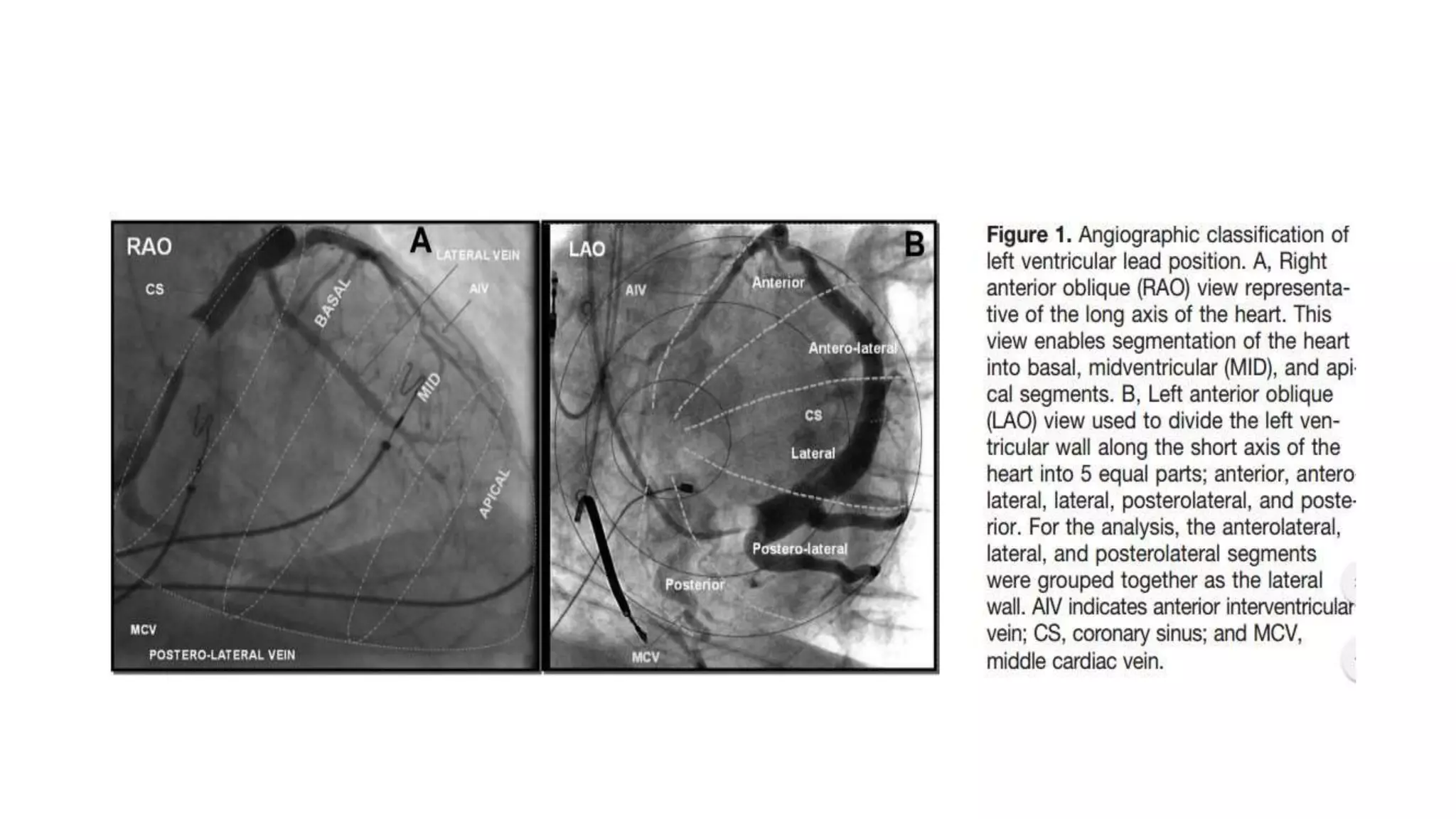 technical aspect of Left ventricular lead placement for CRT | PPTX