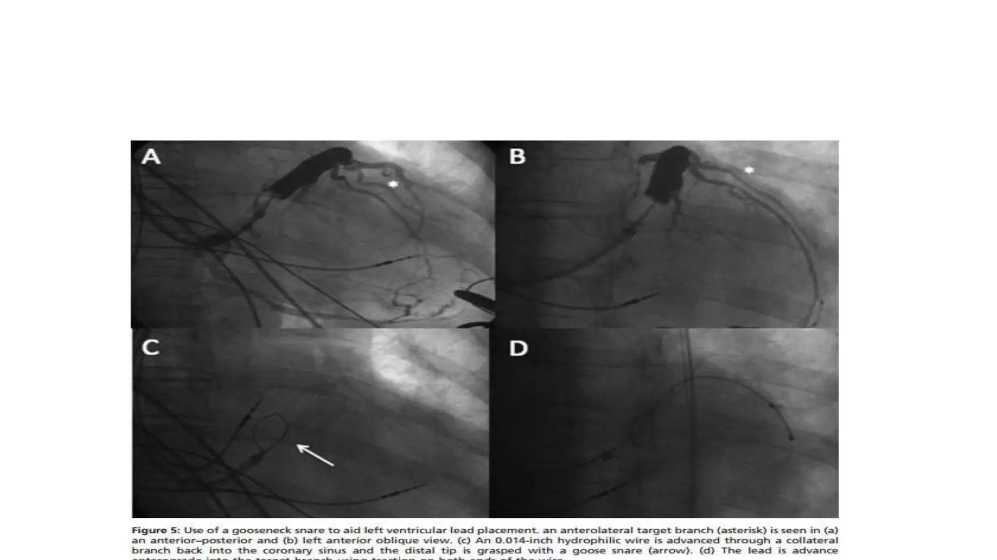technical aspect of Left ventricular lead placement for CRT | PPTX