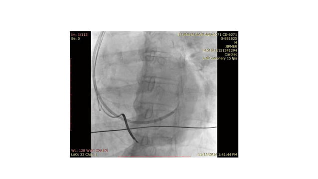technical aspect of Left ventricular lead placement for CRT | PPT