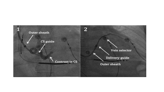 technical aspect of Left ventricular lead placement for CRT | PPT