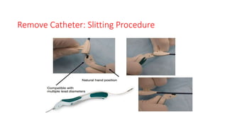 technical aspect of Left ventricular lead placement for CRT | PPTX