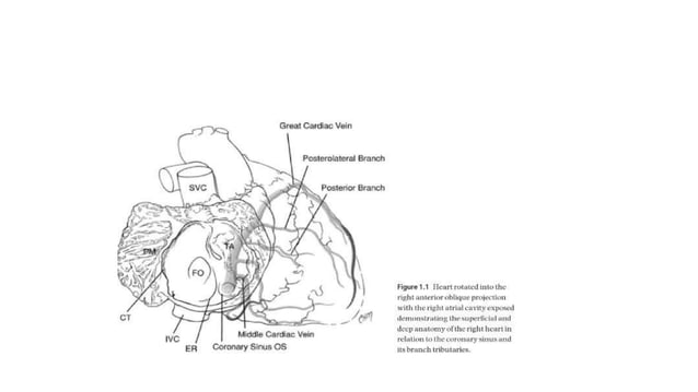 technical aspect of Left ventricular lead placement for CRT | PPT