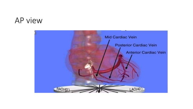 technical aspect of Left ventricular lead placement for CRT | PPT