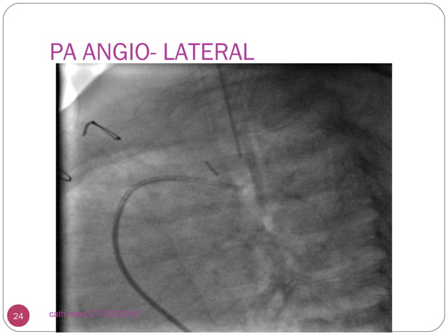 CATH MEET: LPA STENOSIS | PPT