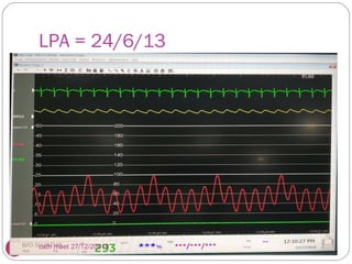 CATH MEET: LPA STENOSIS | PPT