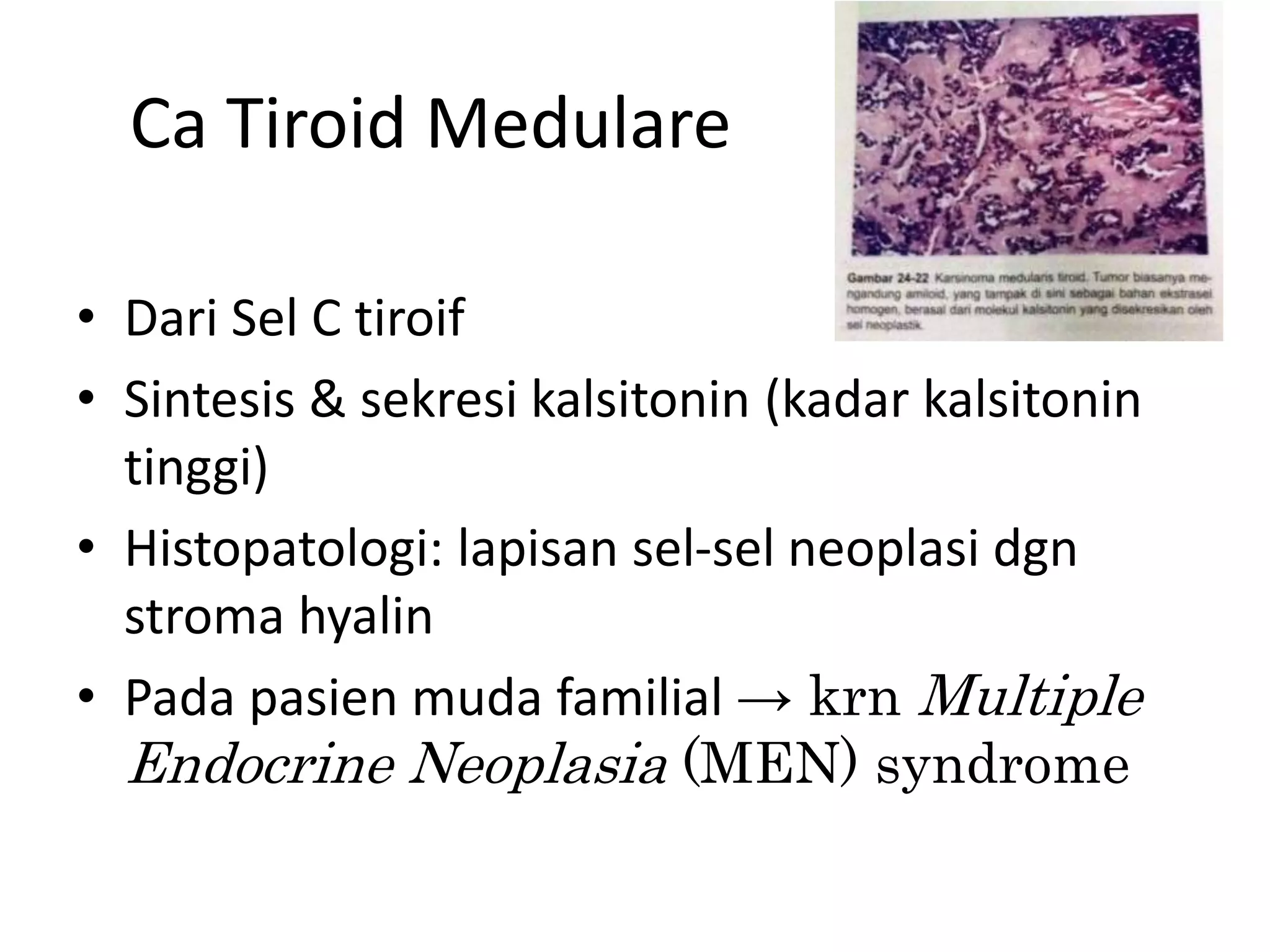 Ca tiroid | PPTX