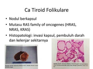 Ca tiroid | PPTX