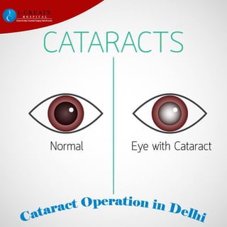 Catract Operation in Delhi | PDF