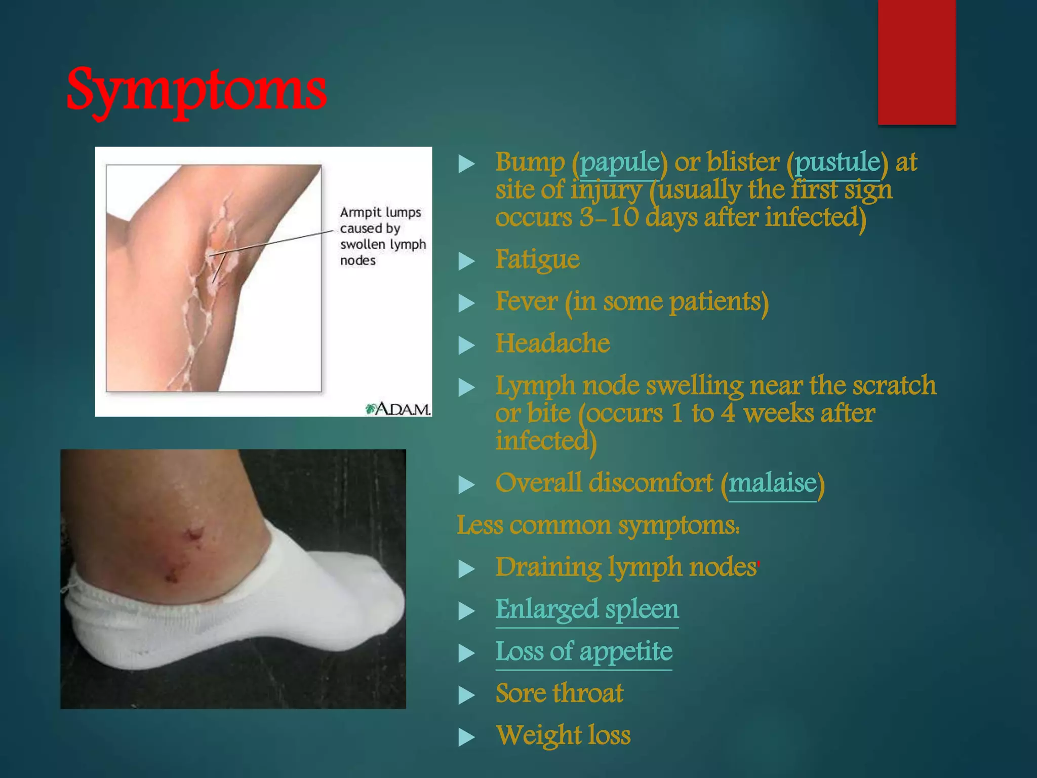 Cat scratch disease | PPTX