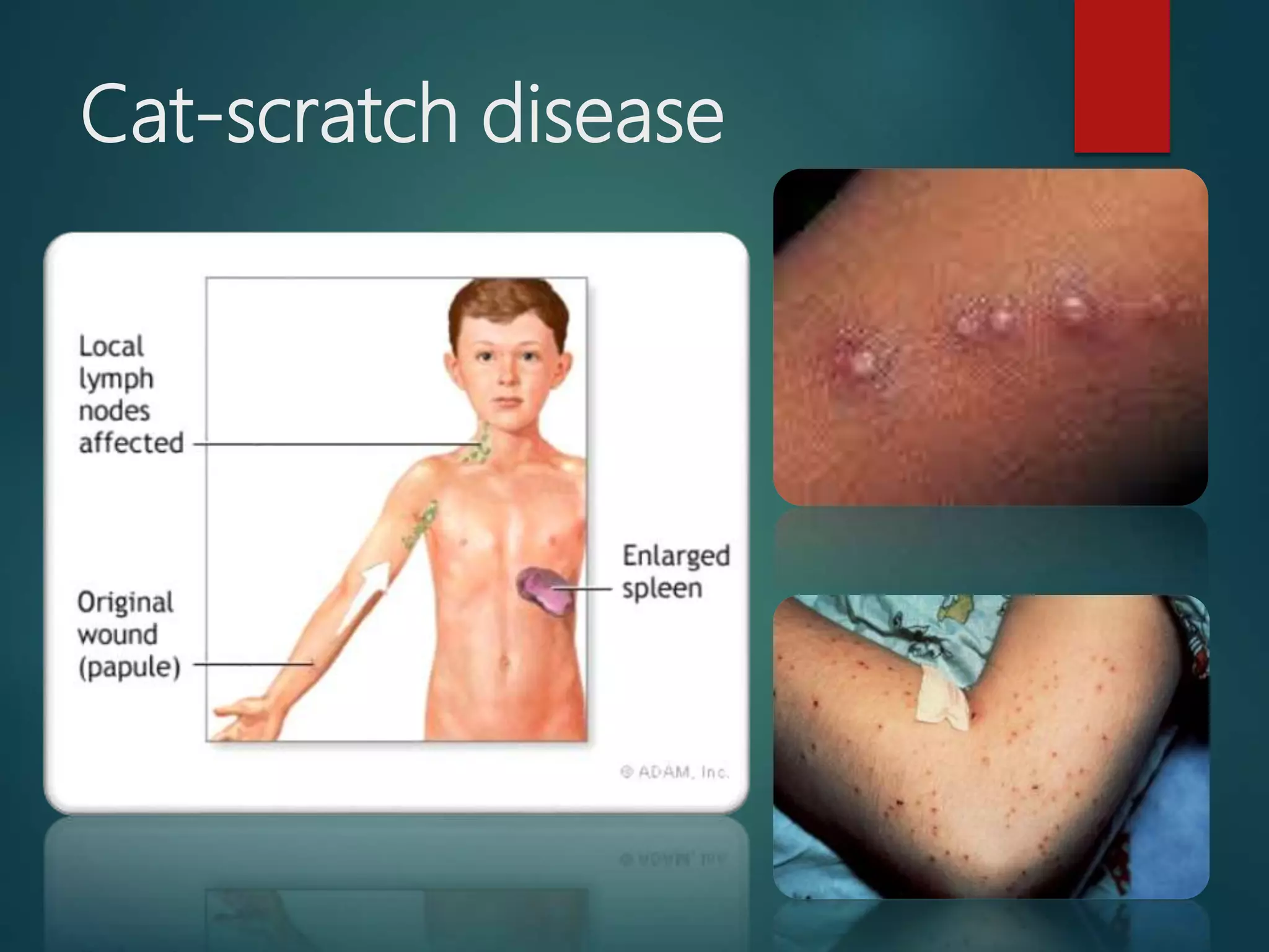 Cat scratch disease | PPTX