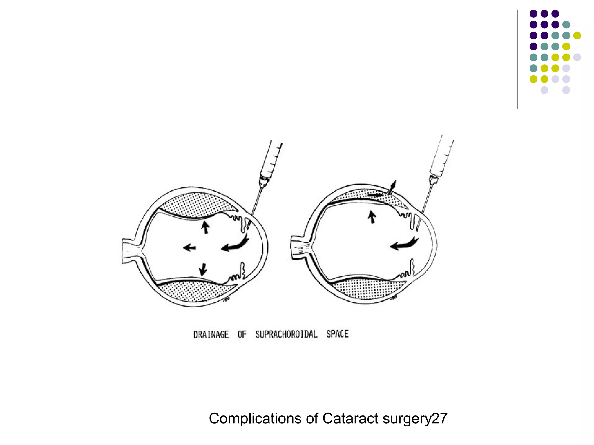 Cataract surgery complications | PPT