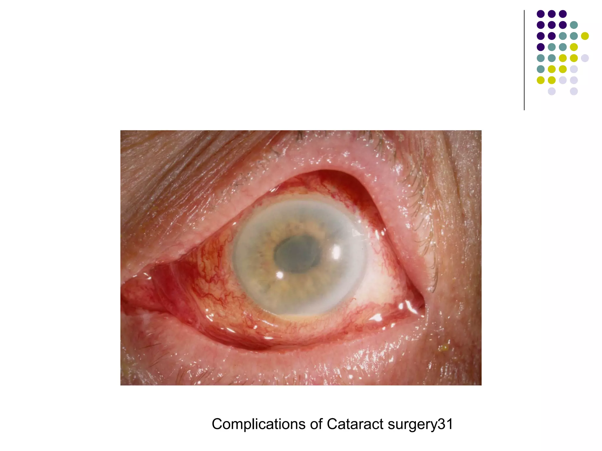 Cataract surgery complications | PPT