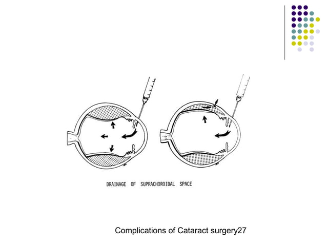 Cataract surgery complications | PPT | Eye and Vision Conditions ...
