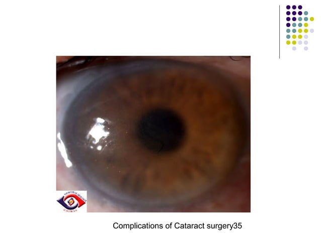 Cataract surgery complications | PPT | Eye and Vision Conditions ...
