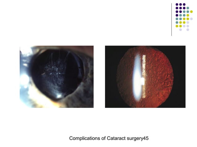 Cataract surgery complications | PPT | Eye and Vision Conditions ...