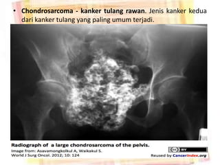 kanker tulang | PPTX