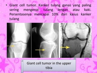 kanker tulang | PPTX