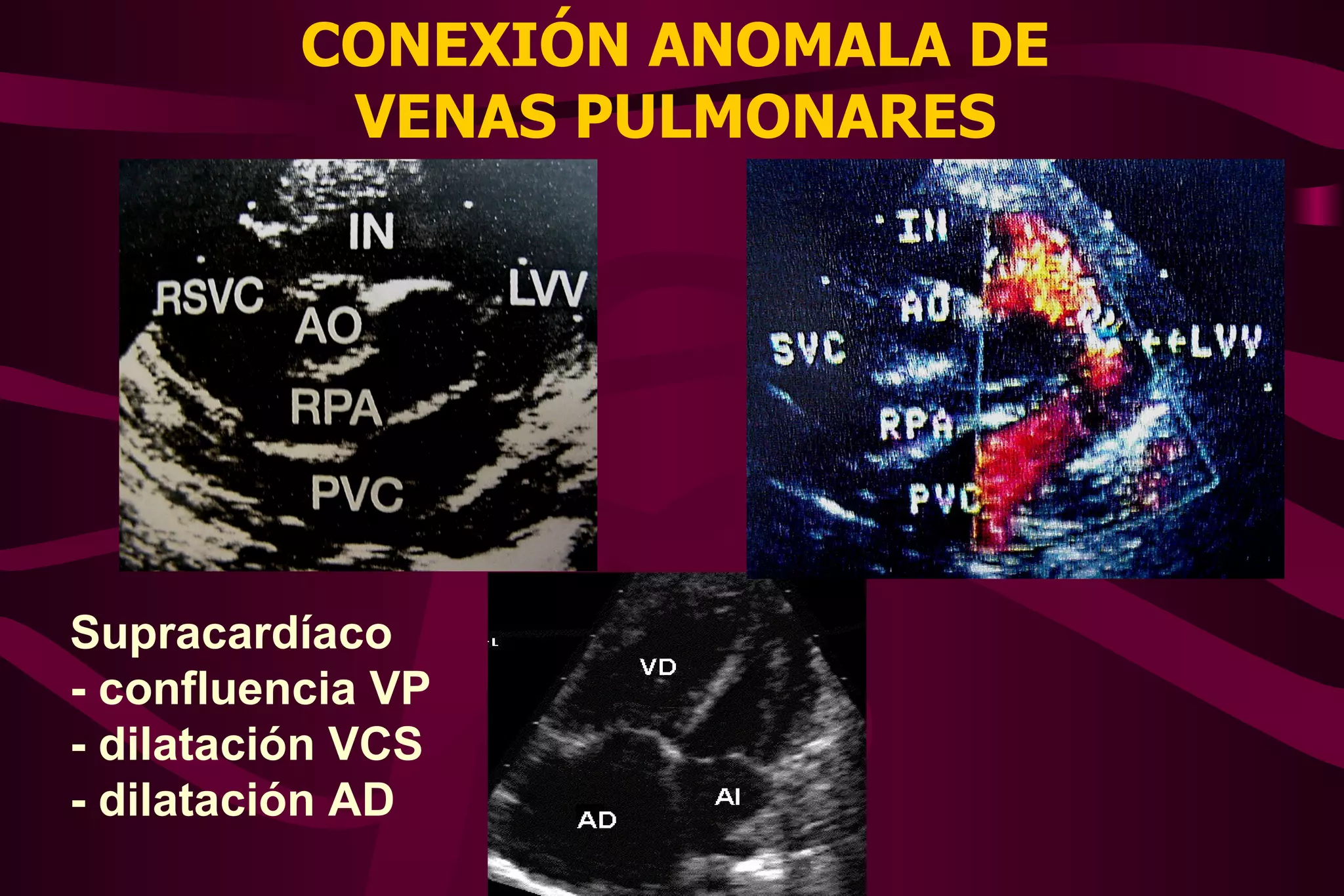 Conexión Anómala de Venas Pulmonares | PPT