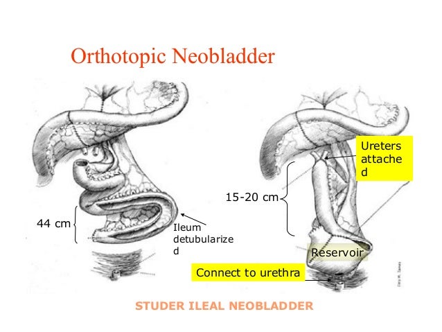 CARCINOMA URINARY BLADDER