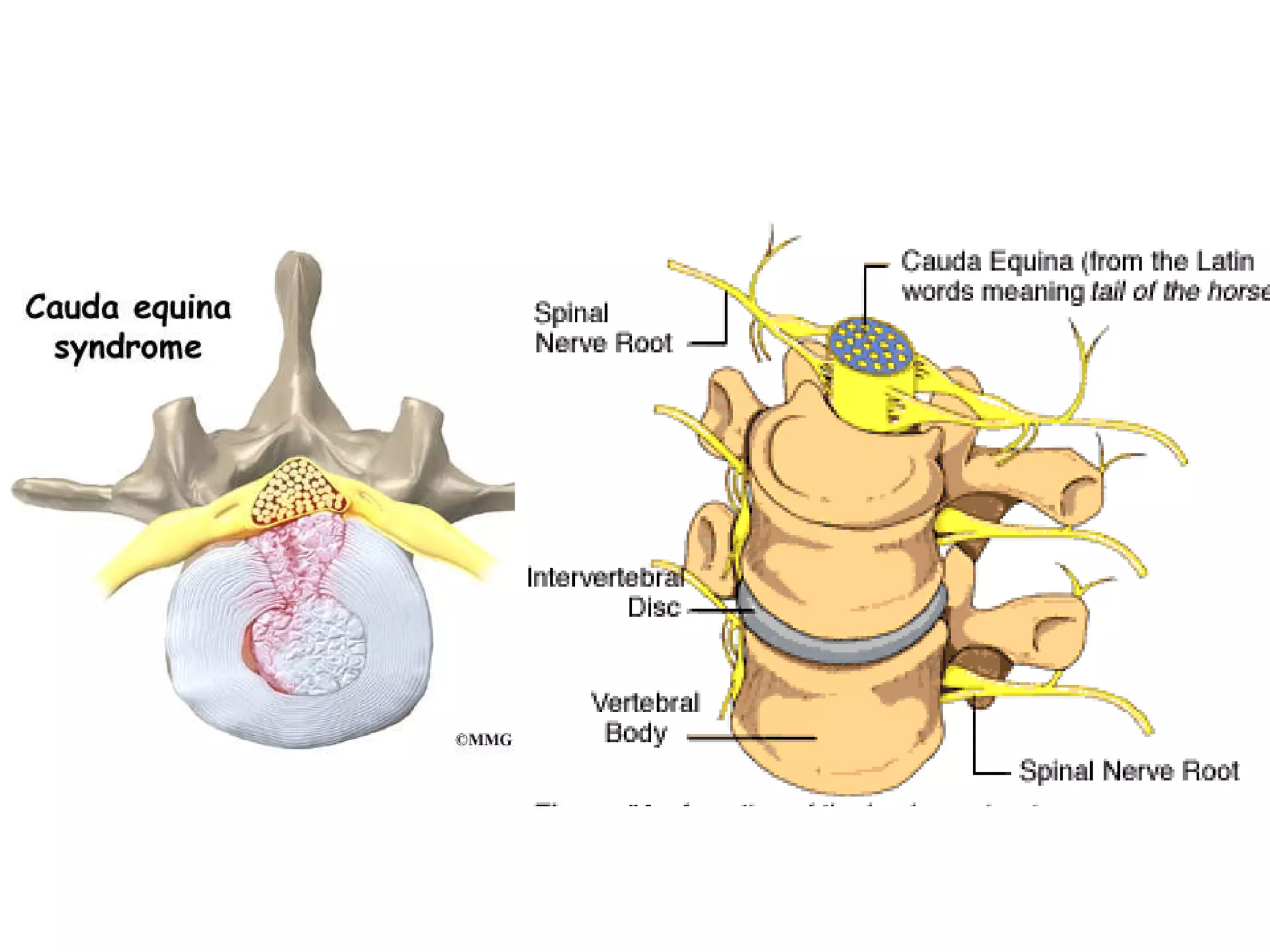 Cauda equina syndrome | PPT