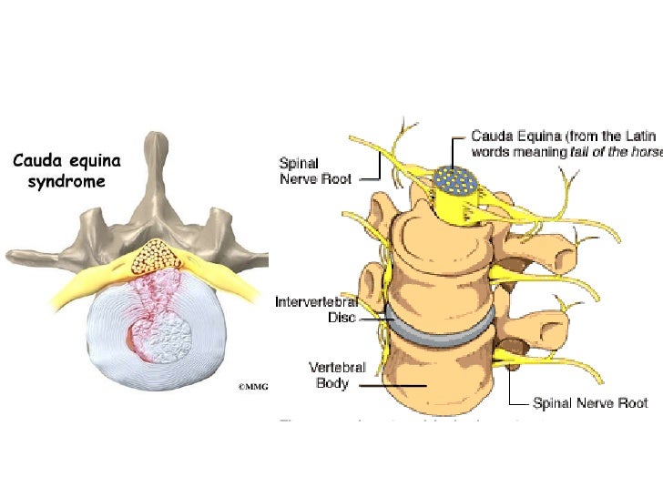Cauda Equina