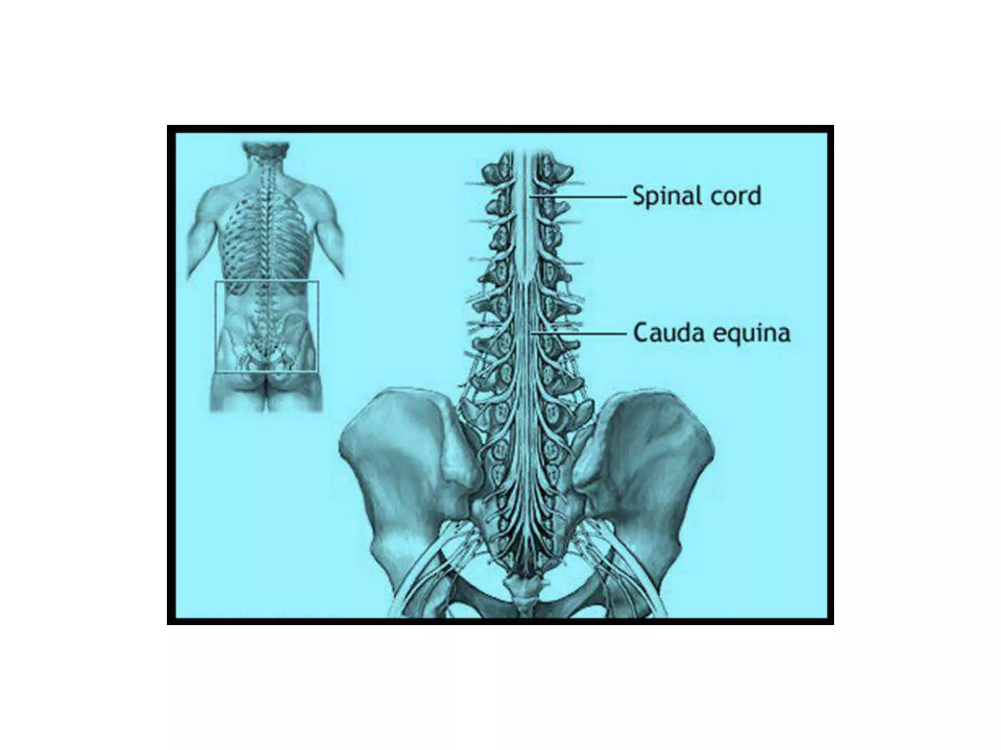 Cauda equina syndrome bowel dysfunction | PPTX