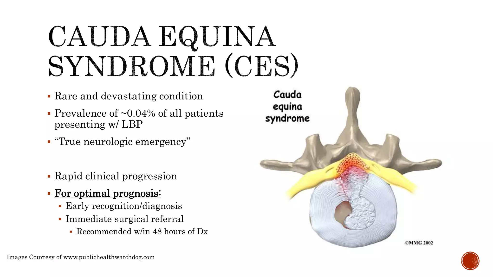 Cauda equina syndrome | PPTX