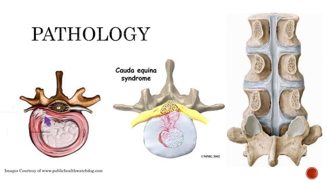 Cauda equina syndrome | PPTX