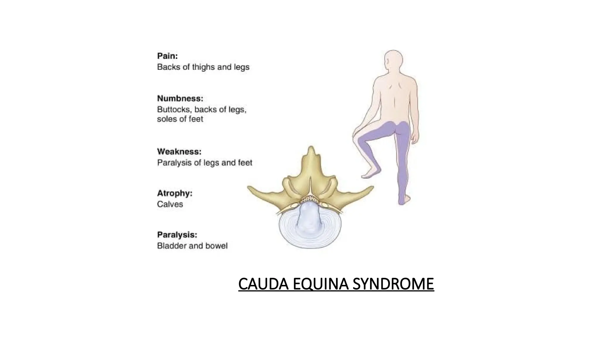 cauda equina syndrome diagnosis treatment ppt.pptx