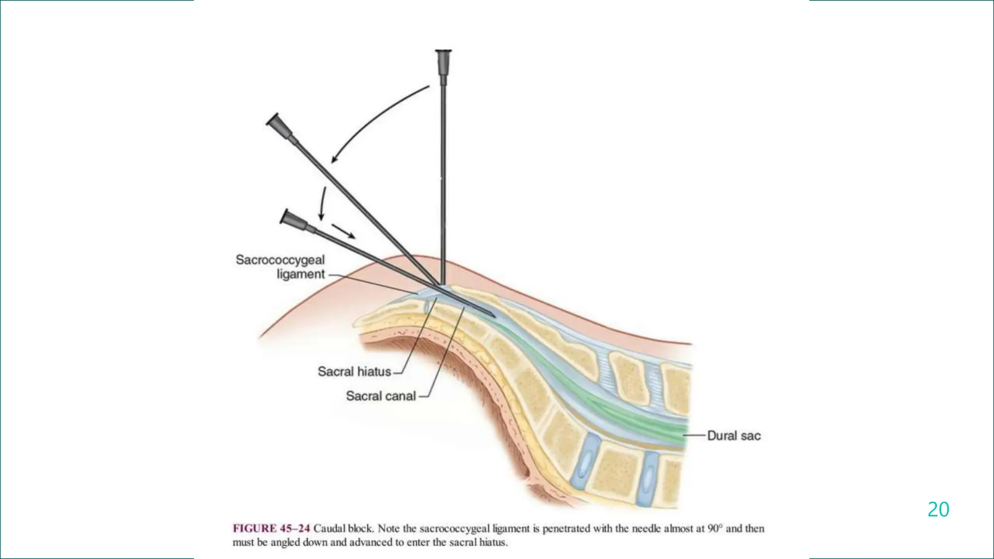 CAUDAL BLOCK and caudal anaesthesia in children | PPTX
