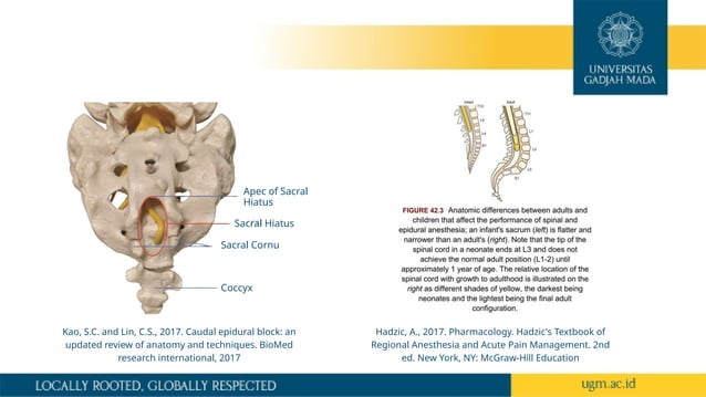 CAUDAL anesthesia regional pediatric.pptx