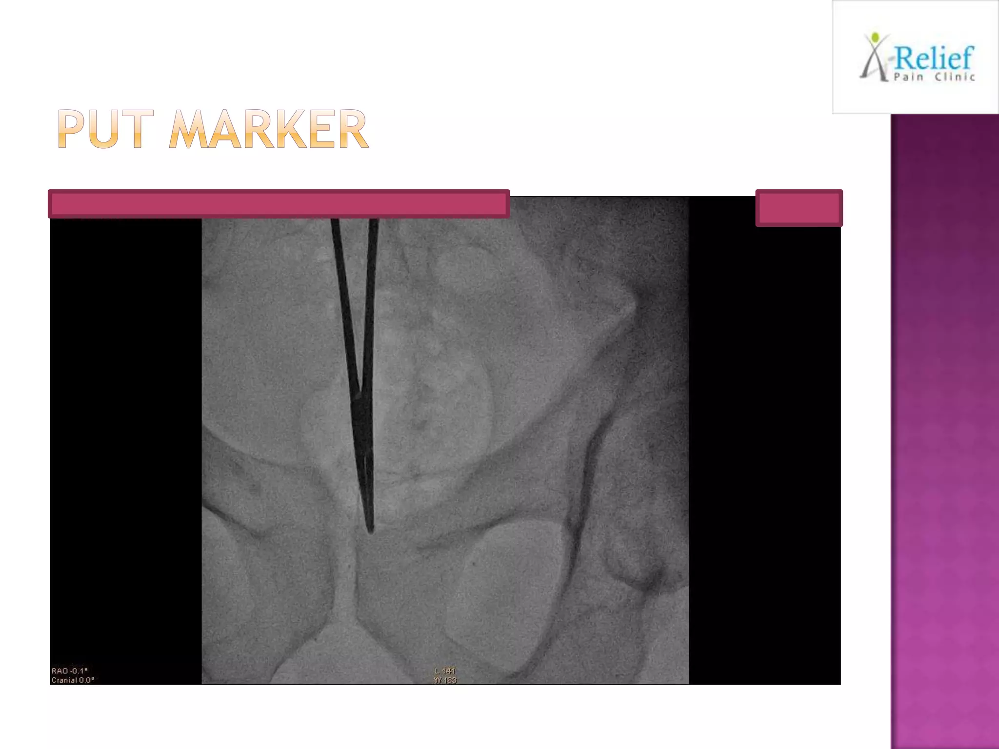 Caudal epidural and ganglion impar block technique dr rajeev harshe | PPSX
