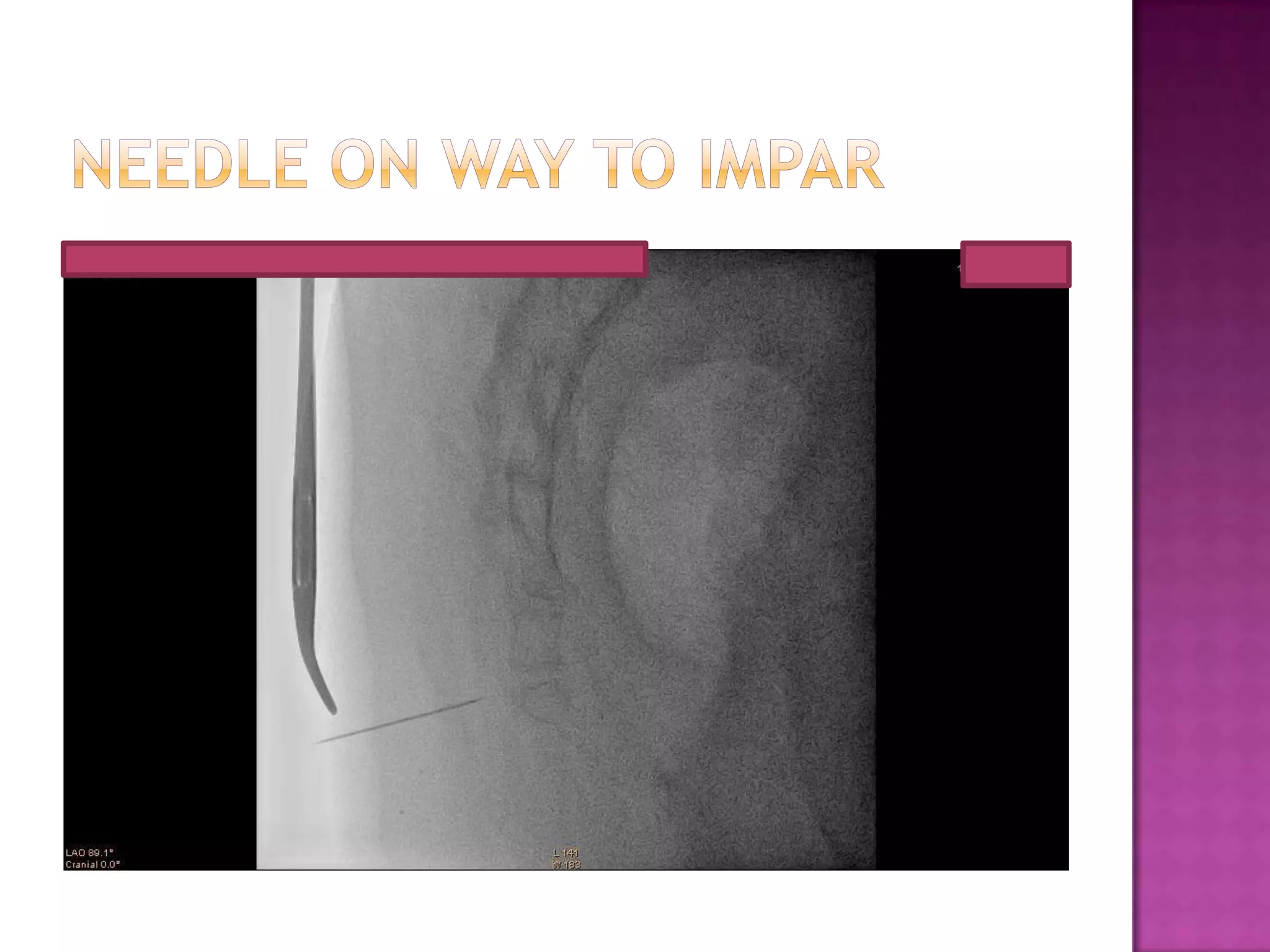 Caudal epidural and ganglion impar block technique dr rajeev harshe | PPSX