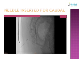 Caudal epidural and ganglion impar block technique dr rajeev harshe | PPSX