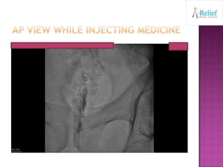 Caudal epidural and ganglion impar block technique dr rajeev harshe | PPSX