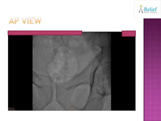 Caudal epidural and ganglion impar block technique dr rajeev harshe | PPSX