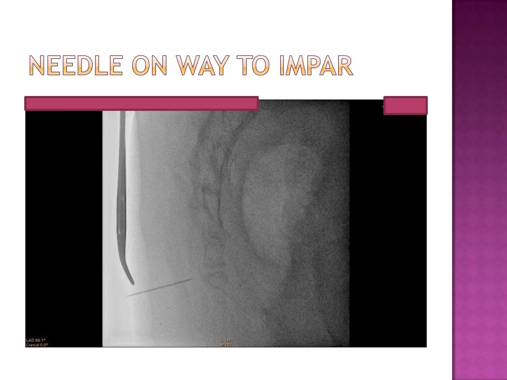Caudal epidural and ganglion impar block technique dr rajeev harshe