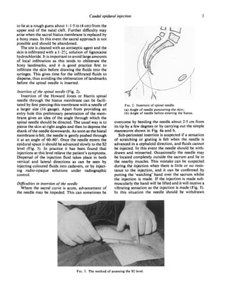 Caudal epidural injection | PDF