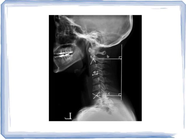 caudal level of cervical fusion.ppt