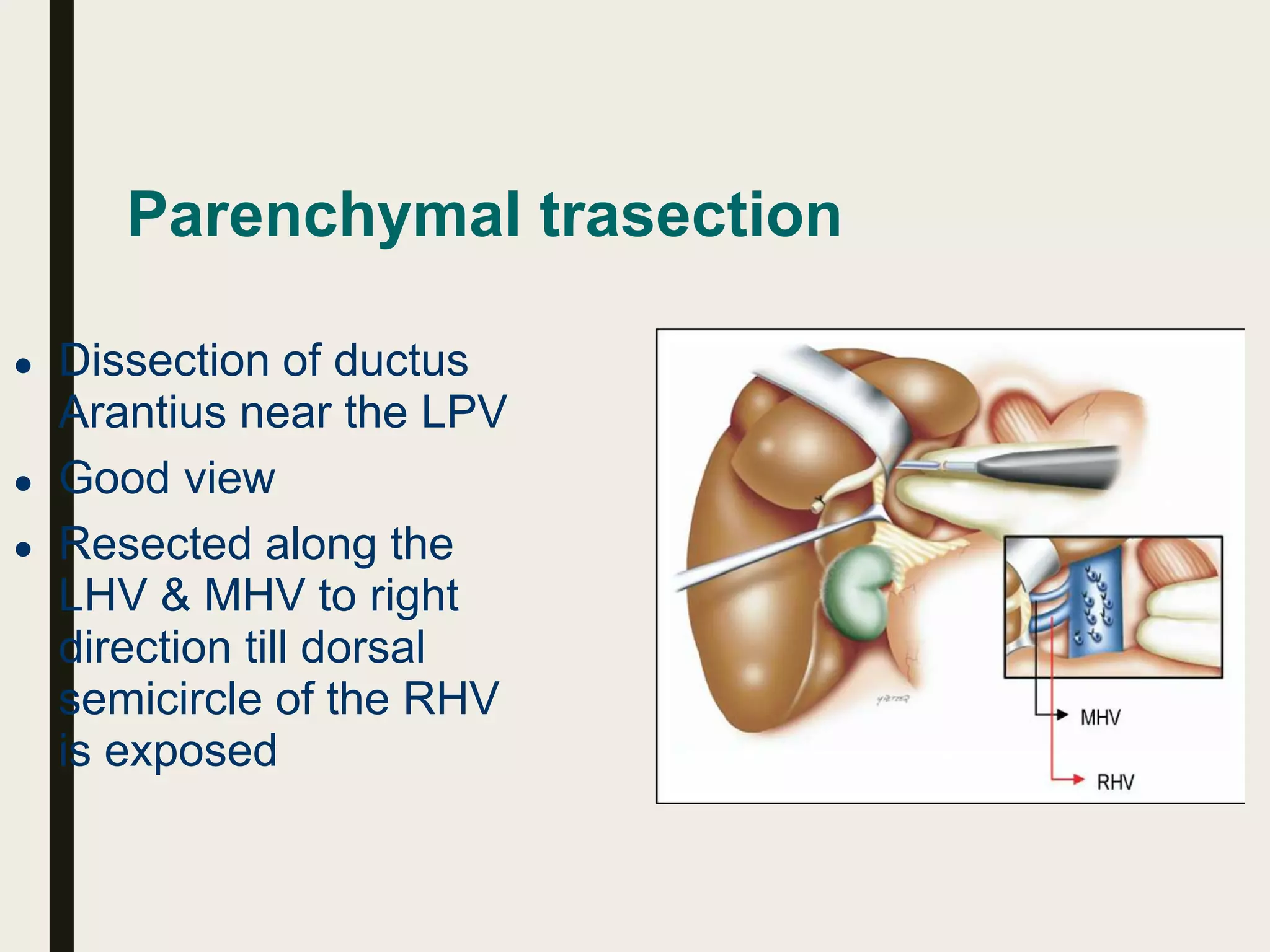 Caudate lobe resection by Dr Harsh Shah(www.gastroclinix.com) | PPT