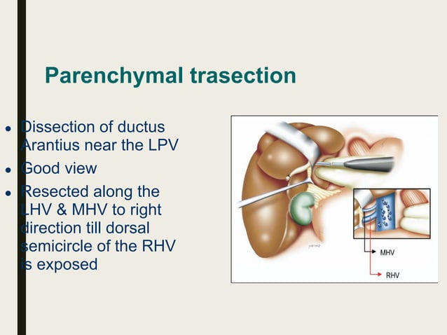 Caudate lobe resection by Dr Harsh Shah(www.gastroclinix.com) | PPT
